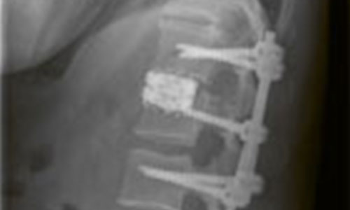 Lumbale Spondylodese – wann lohnt sich diese Operation? | ATOS NEWS